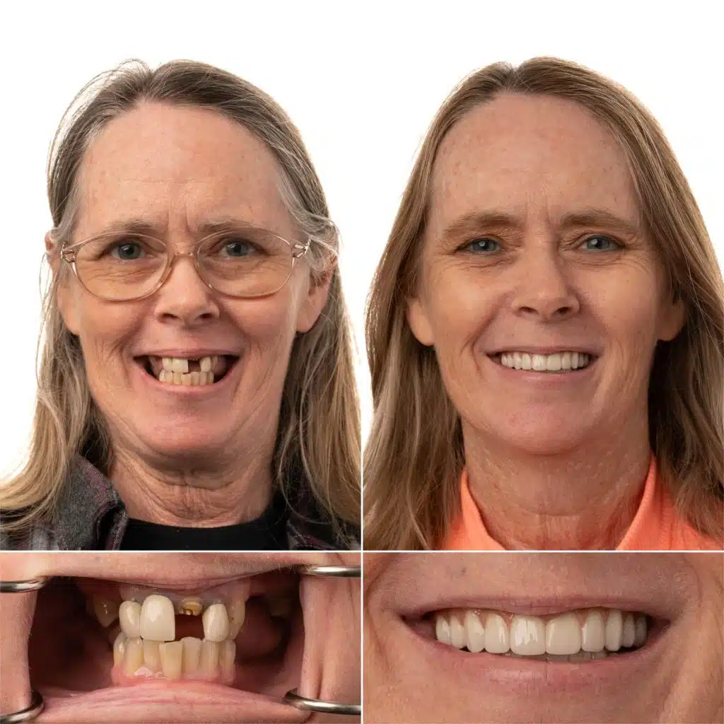 Transformations | Chatt Implants Center in Chattanooga