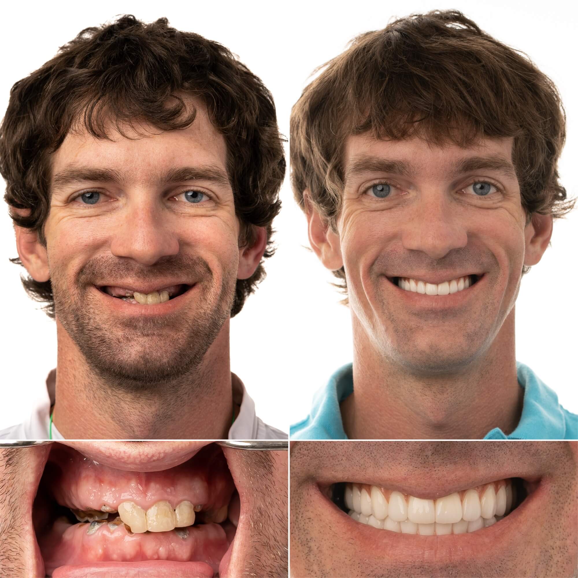 Transformations | Chatt Implants Center in Chattanooga