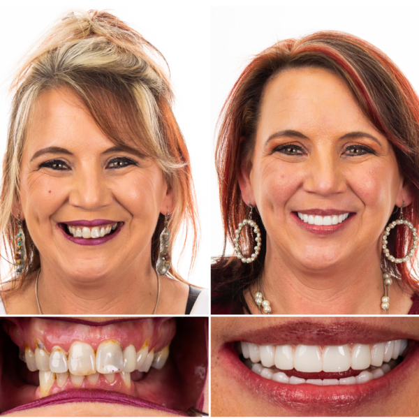 Transformations | Chatt Implants Center in Chattanooga