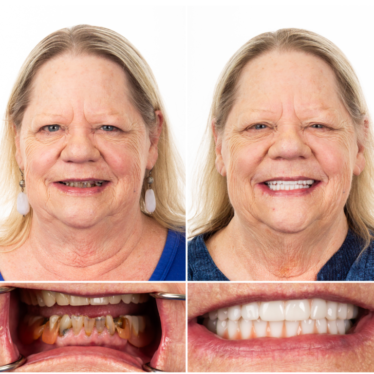 Transformations | Chatt Implants Center in Chattanooga